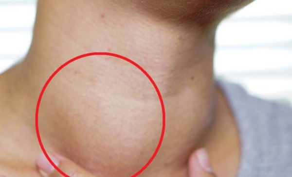 Conoce qué es el bocio y cómo se trata